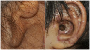 Aural Atresia Repair/Canalplasty – The Microtia and Atresia Clinic at ...
